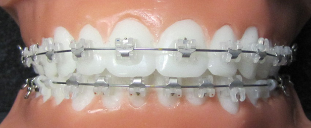 Self-Ligating Braces - Macomb Township MI | Macomb Orthodontics Self-Ligating Braces - Macomb Township MI | Macomb Orthodontics